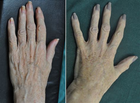 Hand Rejuvenation Dr Dirk Lazarus Plastic Surgeon