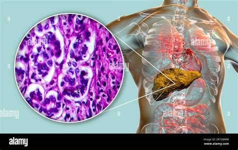 Liver Cirrhosis Computer Illustration And Light Micrograph Of A