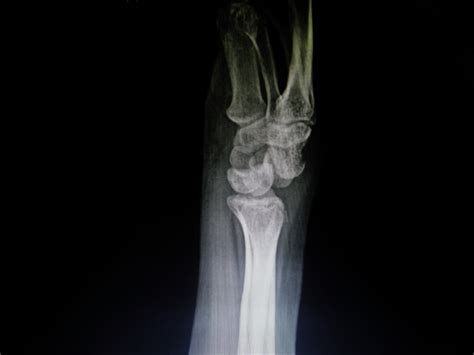 What Is A Scapholunate Ligament Tear Torklaw