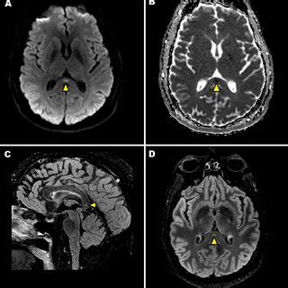 A B Axial DWI MRI Image A And ADC Map B Show An Ovoid Focal