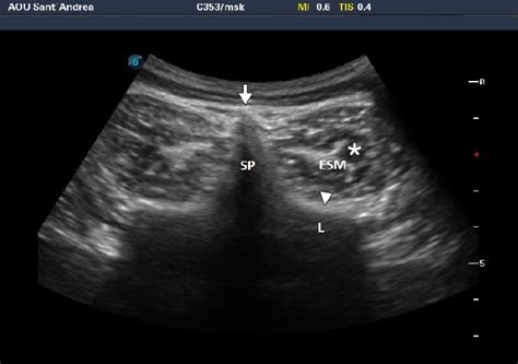 Transverse Spinous Process View When The Transducer Is Positioned