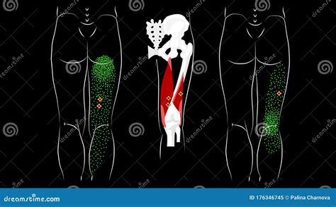 Trigger Points And Reflected Pain In The Hamstring Muscles Stock Illustration Illustration Of