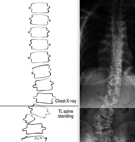 Congenital Vertebral Abnormalities With Hemivertebra Of The 4th Lumbar Download Scientific