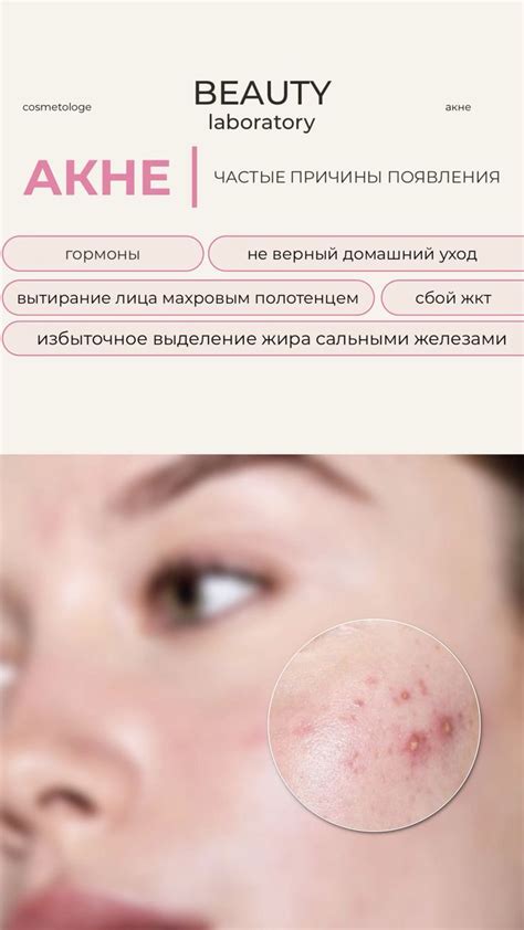 Лечение акне Акне Лечение акне Косметолог