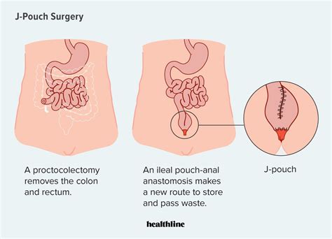 What Is J Pouch Surgery Procedure Risks Recovery And More