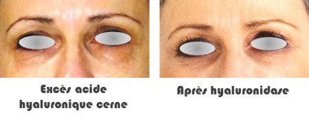 Corriger injections ratées acide hyaluronique par hyaluronidase