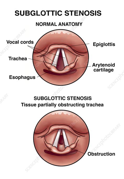 Subglottic Stenosis Illustration Stock Image C0593564 Science Photo Library