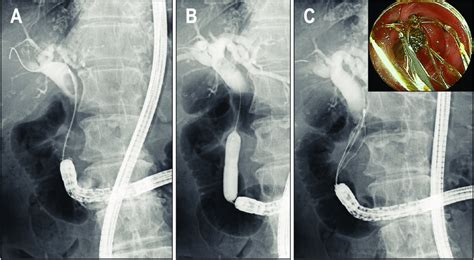 Enteroscopy Assisted Endoscopic Retrograde Cholangiopancreatography