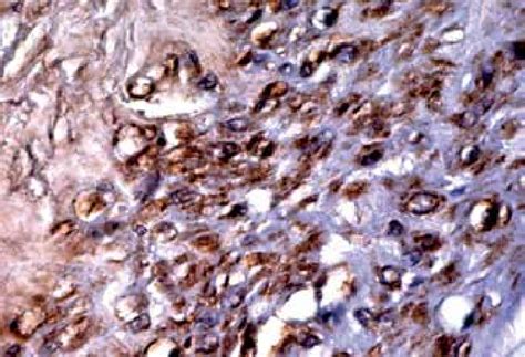 Intense Expression Of The Cd8 Marker In The Artery Wall Of A Patient