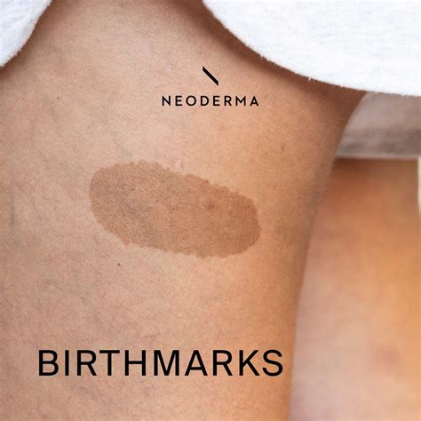 Birthmarks Skin Discoloration Neoderma