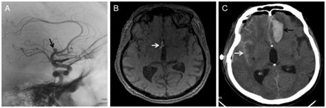 Type D Azygos Anterior Cerebral Artery Of A 58 Year Old Male Patient A