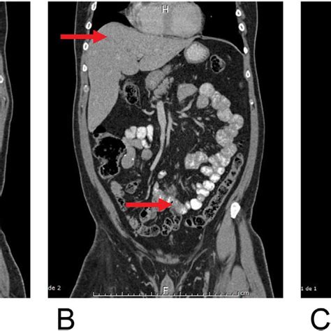 Most Frequent Mutations In Lung Sarcomatoid Carcinoma Download