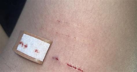 Cat Scratch Bruise R Askdocs
