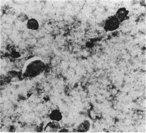 Conjunctivalscrapingshowing Mast Cells Recognised By The Presence