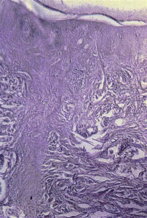 Th E Follicular Epithelium Has Been Replaced By Fi Brous Connective
