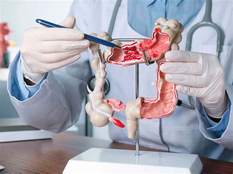 ¿qué Es El Sindrome Del Intestino Irritable Diagnóstico Rojas