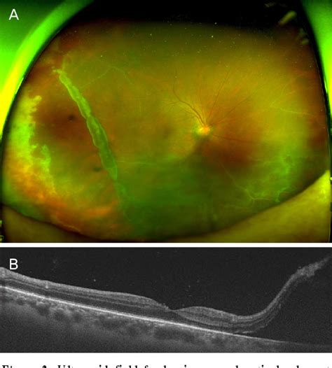 Figure 2 From Retinal Toxicity Following The Injection Ganciclovir Into Silicone Oil Filled Eye