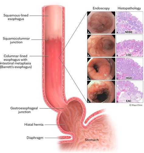 Advances In Screening For Barrett Esophagus And Esophageal