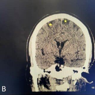 1 A Sagittal 1B Coronal And 1 C Axial Non Contrast CT Of The Brain