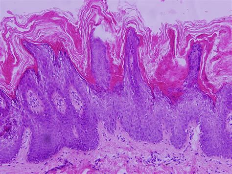 Erythrokeratodermia Variabilis