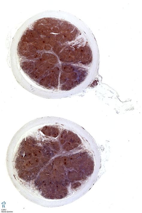 Digestive Lymphoid Hyperplasia Human Pathology