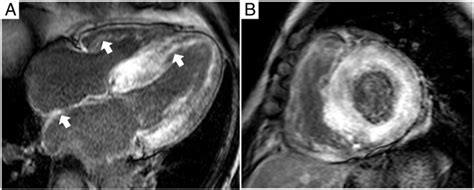 Representative Cmr Image Of A Patient With Attrwt‐cm In A Short‐axis Download Scientific