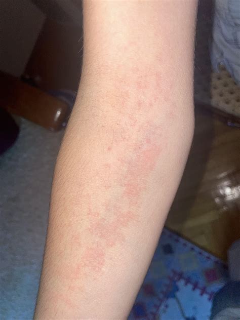 Skin Rash R Skincare Addiction