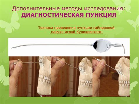 Одонтогенные верхнечелюстные синуситы презентация онлайн