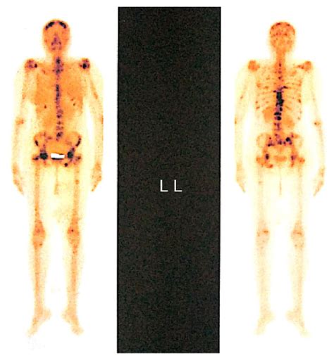 Whole Body Bone Scan Performed In 45 Year Old Patient With Left Breast