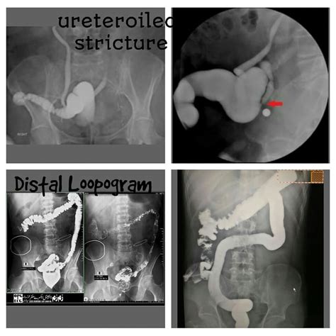 Loopogram A Delhi Radiologic Technologist Group