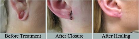 Earlobe Repair Aesthetic And Dermatology Center Rockville Md