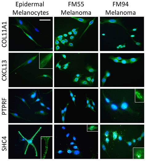 A New 12 Gene Diagnostic Biomarker Signature Of Melanoma Revealed By