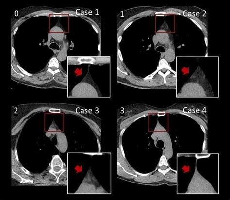 Immune System Aging Can Be Revealed By CT Scan Of Thymus Research Suggests Lifeboat News The