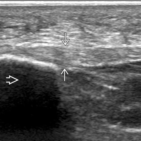 Plantar Fasciitis And Fibromatosis Radiology Key