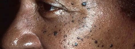 Can Genital Warts Be Spread By Razors At Natalie Murray Blog