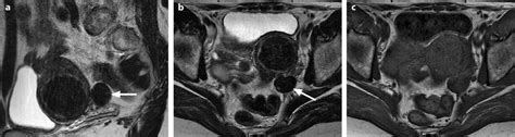 Sex Cord Stromal Tumors Radiology Key