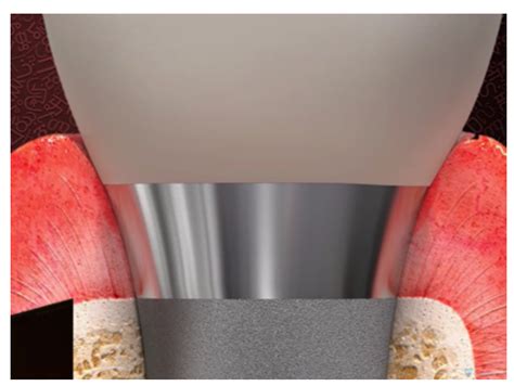 Soft Tissue Implant Integration Part 2