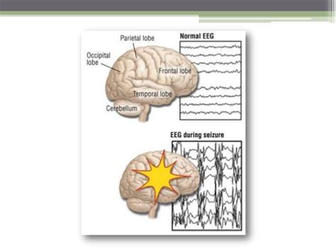 Complex Partial Seizures