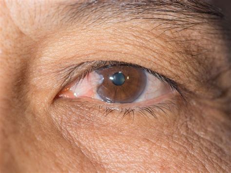How To Treat Pterygium Without Surgery Anaheim Eye Institute