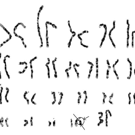His Mothers Karyotype Shows A Balanced Non Robertsonian Translocation