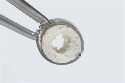 Bone Augmentation And Simultaneous Implant Placement With Allogenic