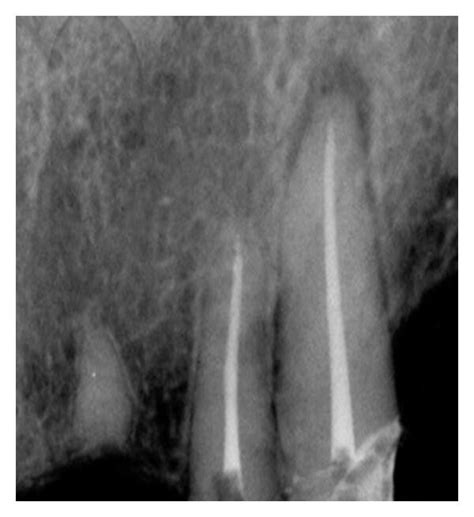 Restoration Of Endodontically Treated Teeth Review And Treatment Recommendations Slutzky