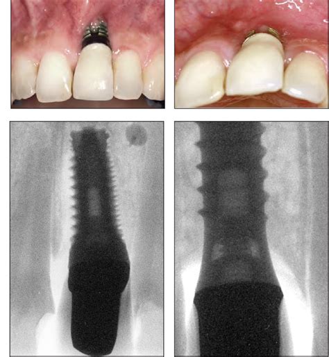 Periodontal Probe Semantic Scholar