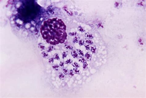 Chagas Disease Emerging As Us Public Health Threat