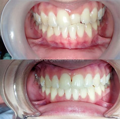 Behel Gigi Orange Dental