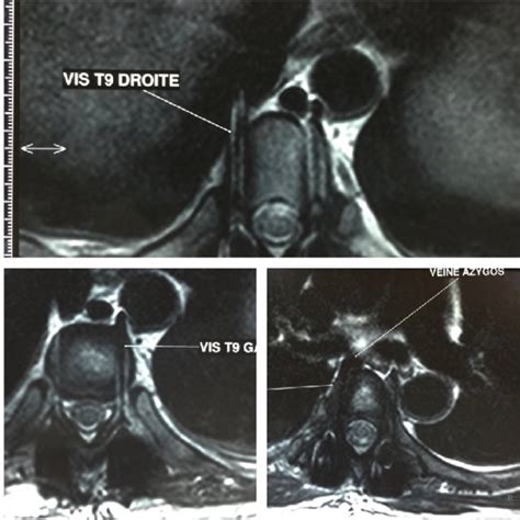 Fracture Dislocation Of T7 T8 With Burst Fracture Of T7 And T8 Download Scientific Diagram