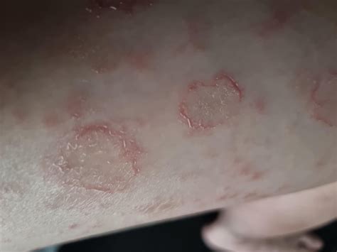 Large Circular Rash Rpityriasisrosea Large Circular Rash Rpityriasisrosea