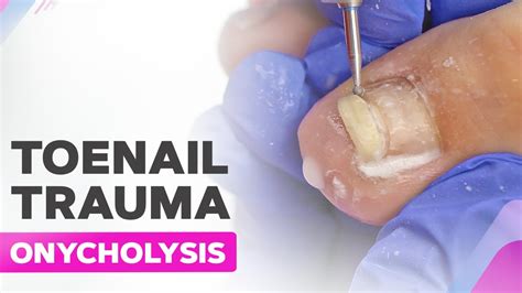 Onycholysis Toenail