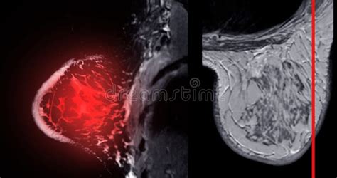 Breast Mri Revealing Bi Rads 4 In Women Indicates Suspicious Findings Warranting Further