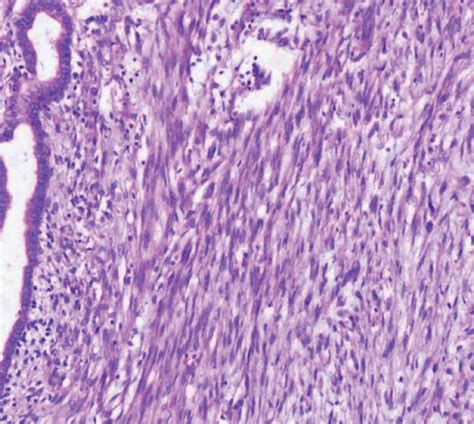 Histological Section Reveals A Interlacing Fascicles Of Bland Spindle